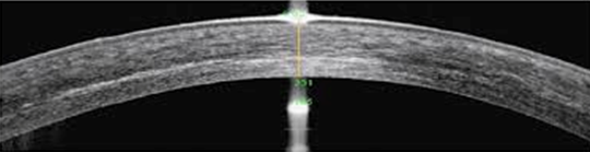 Collagen crosslinking for keratoconus | Refractive Surgery Course